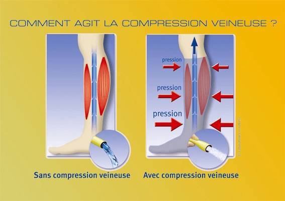 Compression par bas de contention pour prévenir les troubles veineux ...